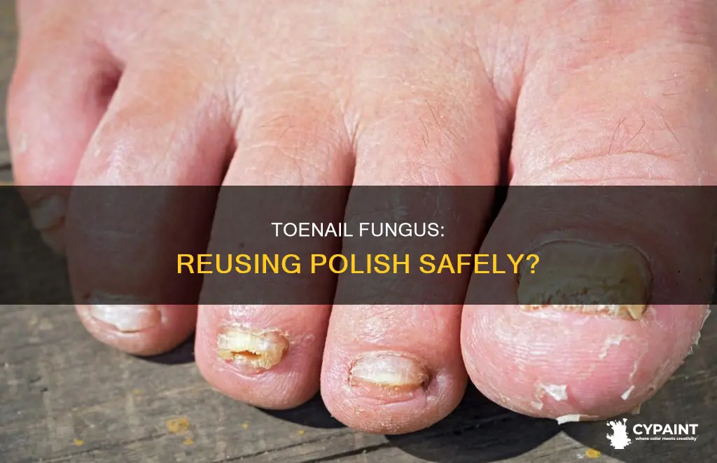 Toenail Fungus: Reusing Polish Safely? | CyPaint