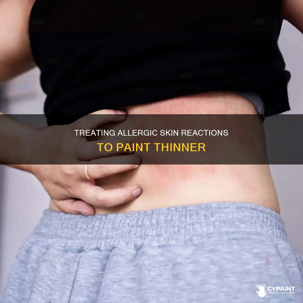 Treating Allergic Skin Reactions To Paint Thinner | CyPaint